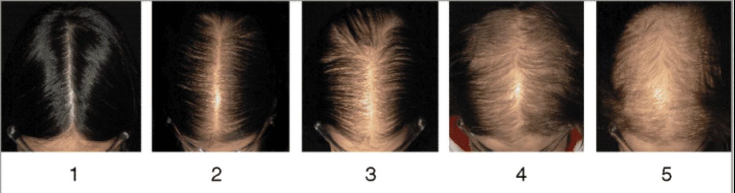 Why Do We Lose Hair as we Age?- Everything you need to know about Male ...
